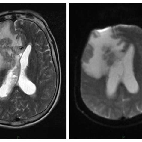 Ct Brain Non Contrast An Irregular Shaped Hypodense Mass 405mm X