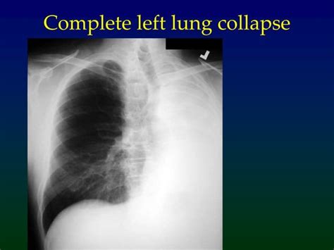 Atelectasis The Lung Condition And Management Ppt