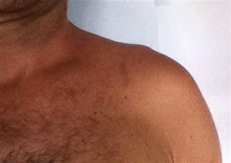 The Clavicle May Be Prominent Enough To Tent The Skin Download