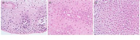 Increasing Grades Of Severity Of Dilated Intercellular Spaces Dis In Download Scientific