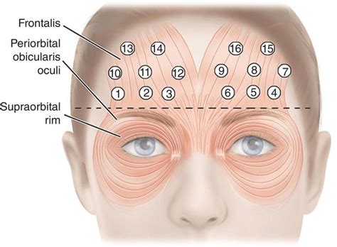 Frontalis Muscle Botox