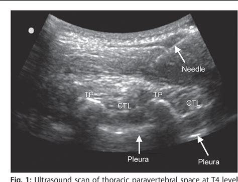 Figure 1 From Thoracic Paravertebral Block As An Alternative To General Anesthesia In Patients