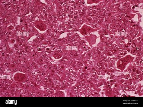 Thyroid Gland Cancer Light Micrograph Of A Section Through A Thyroid