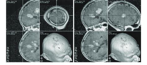 Neuronavigation System Images Demonstrating Before A And After B