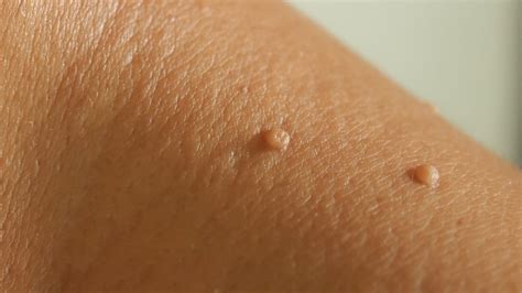 Symptoms Prevention Treatment And Causes Of Skin Tags