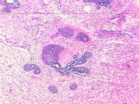 Primary Renal Teratoma A Rare Entity Pmc
