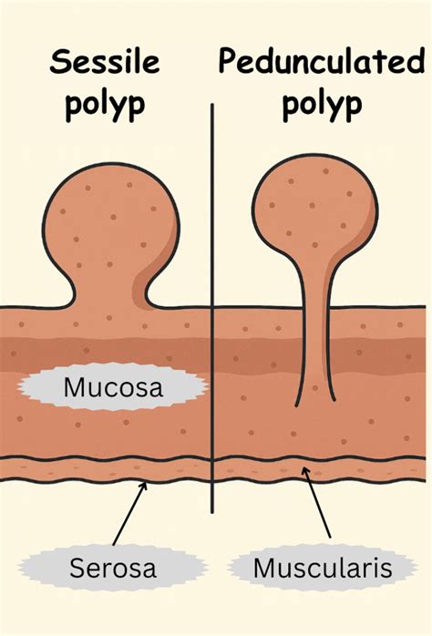 Understanding Neoplastic Colon Polyps Sessile Vs Pedunculated Vs Villous Canadian Path Assistant