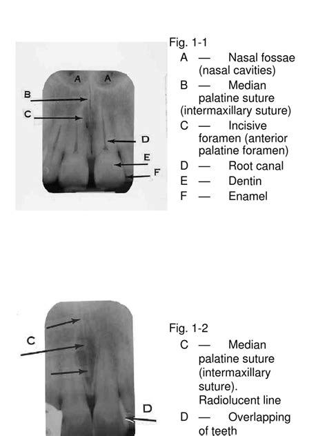 Normal Radiographic Dental Anatomy Mouth Human Anatomy