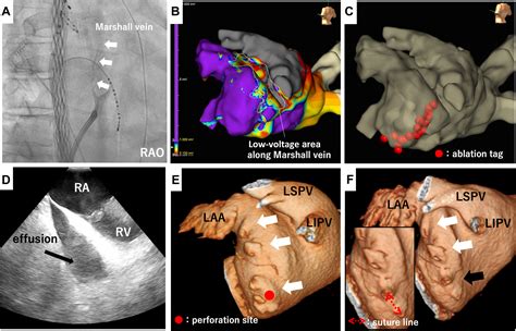 Life Threatening Cardiac Tamponade Caused By Perforation Of An