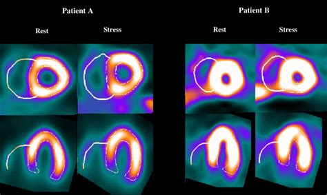 Two Patients Right Ventricular Mid Myocardial Model And Left Ventricle Download Scientific