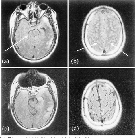 Basal Cisterns Axial Ct