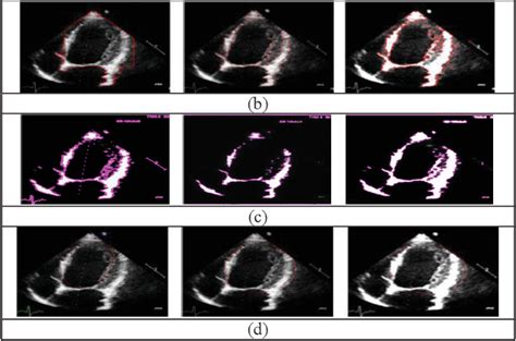 Figure 2 From A Study On Various Segmentation Approaches Using Echocardiogram Images For