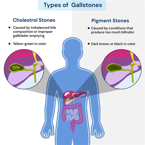 Gallbladder Stones Symptoms