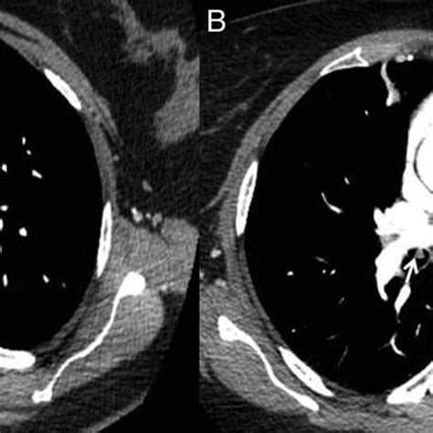 Contrast‐enhanced Chest Computed Tomography Ct Showed A Vascularized