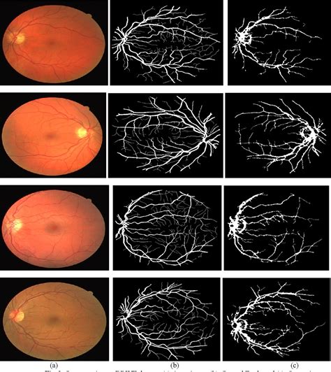 Figure 1 From Unsupervised Vessel Segmentation Technique Using Ltp And Pca Semantic Scholar