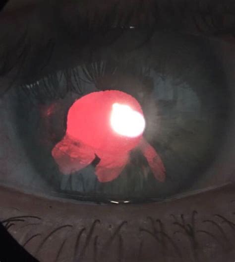 Hosam Salah On Linkedin Patches Of Iris Atrophy By Retroillumination