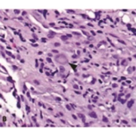 Colonoscopy Images Extensive Involvement Of The Terminal Ileum With Download Scientific