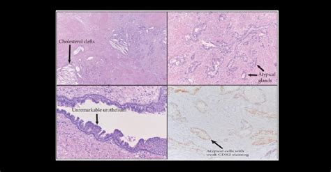 Diagnosis Of Cystic Mass In Pelvic Area Medsynapse