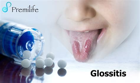 Glossitis Cancer