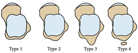 Variations In The Posterolateral Tubercle Of Talus 1 Almost Absent