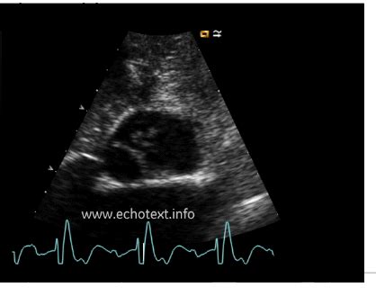 Echo Images Flashcards Quizlet Echo Images Flashcards Quizlet