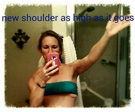 After Scapular Fusion Surgery Big Improvement Muscular Dystrophies