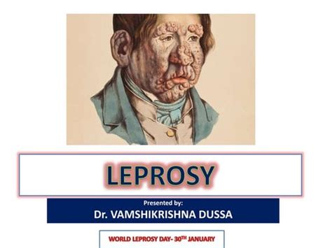Leprosy Hansen Disease Types Clinical Featurespptx