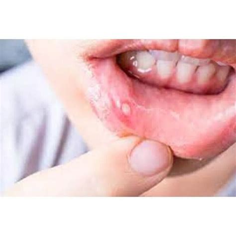 Candid Mouth Paint For Oral Thrush Treatment For Kills Fungal 25gm Ebay