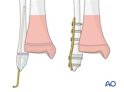 Open Reduction Screw Fixation For Complex Epi Metaphyseal Fractures Of The Distal Tibia Triplane
