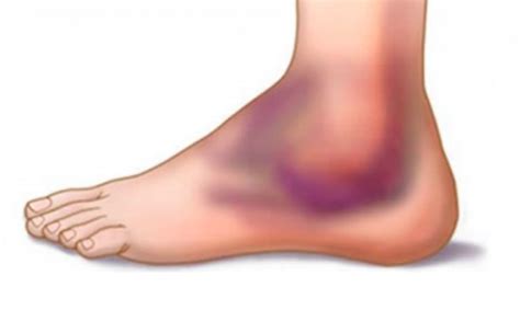 Comment Soigner Une Inflammation Du Duodénum Sport Mode Beauté And Lifestyle