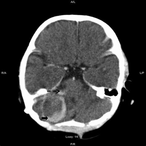An Axial View Of Ct Brain Showed A Right Cerebellar Cavernoma Full