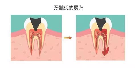 大连齿医生口腔 医生什么是牙髓炎牙髓炎可以自愈吗 搜狐大视野 搜狐新闻