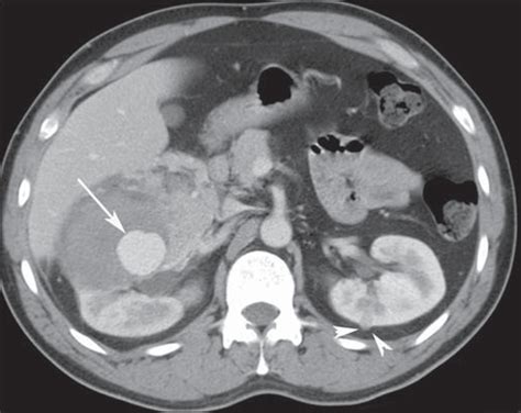 Brasil Imaging Of Tuberous Sclerosis Complex A Pictorial Review