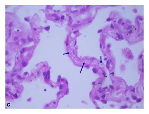 Liver Biopsy Shows Numerous Spherical Organisms In The Sinusoidal