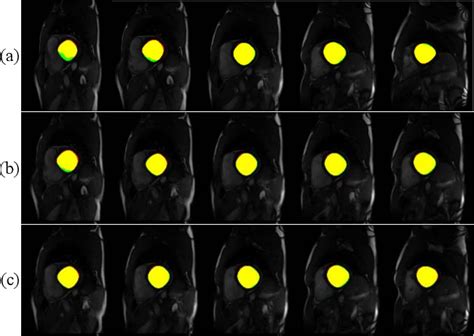 Figure 2 From Left And Right Ventricular Segmentation Based On 3d Region Aware U Net Semantic