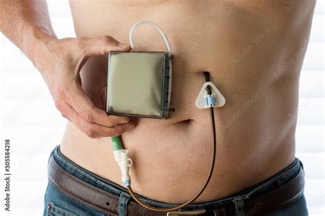 A Parkinsons Disease Patient Displaying A Surgically Installed Peg J Tube Which Carries