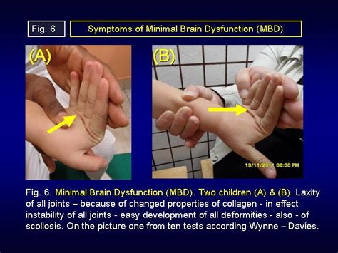 Minimal Brain Dysfunctions Mbd Causes Clinical Symptoms Deformity