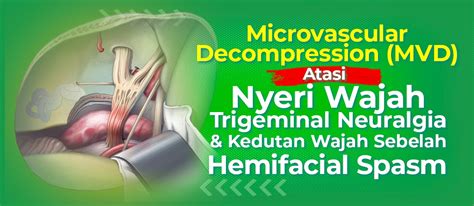 Trigeminal Neuralgia