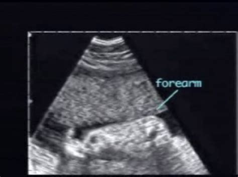 Radial Ray Defects Ultrasoundpaedia