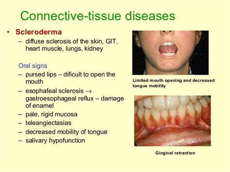 Oral Manifestations Of Systemic Diseases