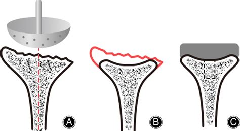 Diagrams Of Eccentric Reaming Technique Bone Defect Often Resulted In
