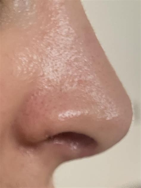 Rhinoplasty Ive Already Had Alar Batten Grafts Inserted But One Of My Nostrils Is Much Higher