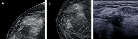 Architectural Distortion With Corresponding Sonographic Mass Download Scientific Diagram