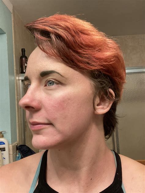 3 Months On Doxycycline Oral And Ivermectin Topical Treatment R Rosacea