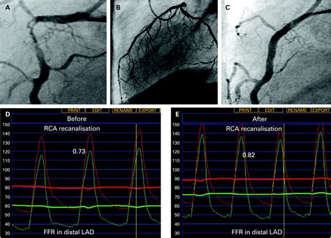 Fractional Flow Reserve A Review Heart