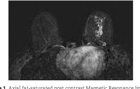 Figure 1 From Diagnosis And Management Of Breast Implant Capsule