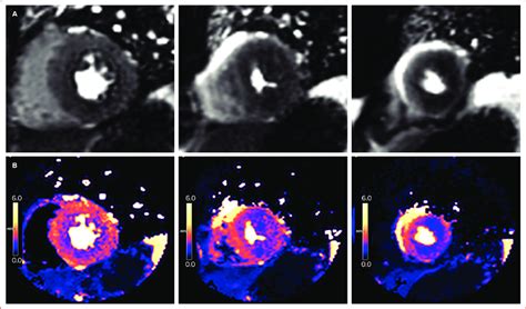 Role Of Cardiac Magnetic Resonance In Assessing Microvascular