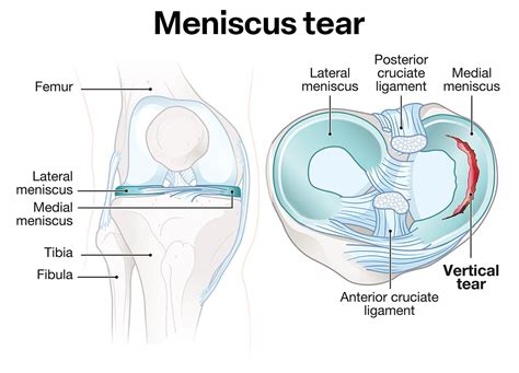 Lateral Meniscus Anatomy Meniscus Injuries And Management Home