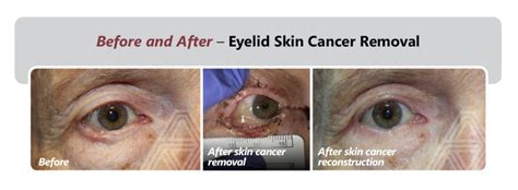 Eyelid And Facial Skin Cancer Triad Eye Institute