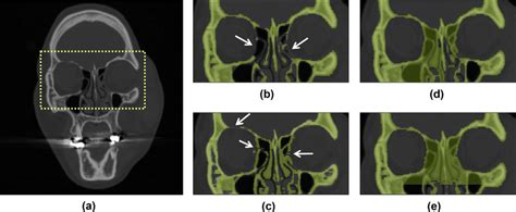 Comparisons Of Various Segmentations In Two Dimensional Slice Images Download Scientific
